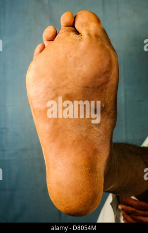 A foot with actinomycetoma Stock Photo - Alamy