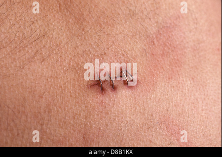 Stapled wound after surgery Stock Photo - Alamy