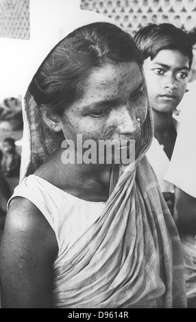 Woman with Smallpox Stock Photo - Alamy