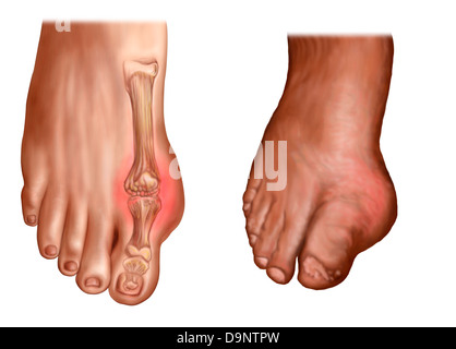 Anatomy of a swollen foot Stock Photo - Alamy