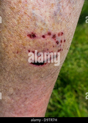 Dog Bite Scar Stock Photo - Alamy