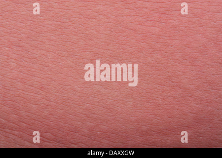 Example sunburn heat burning rash skin Stock Photo - Alamy
