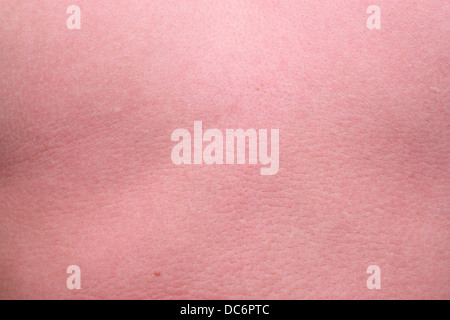 Example sunburn heat burning rash skin Stock Photo - Alamy