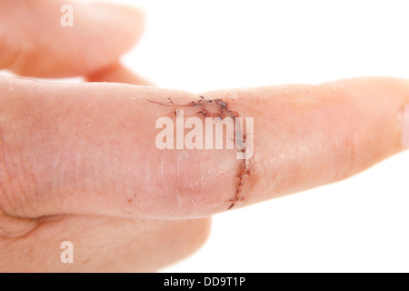 Laceration scar. Laceration (cut) scar on the shin of an 86-year-old ...