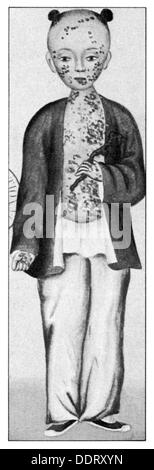 Woman with Smallpox Stock Photo - Alamy