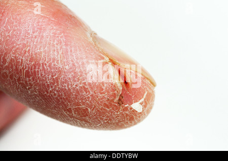Mans fingertip split due to cold weather against a white background ...