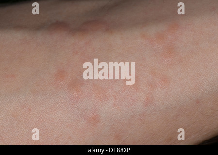 stinging nettle (Urtica dioica), irritation of skin by Stinging Stock ...