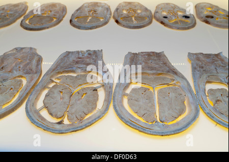 Brain, Transverse Section Stock Photo - Alamy