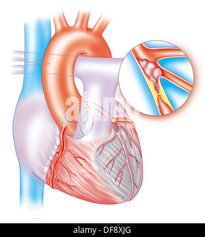 HEART ATTACK, DRAWING Stock Photo - Alamy