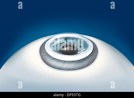 CORNEAL TRANSPLANT, DRAWING Stock Photo - Alamy