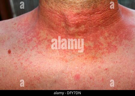 Itchy Rash On Neck And Chest