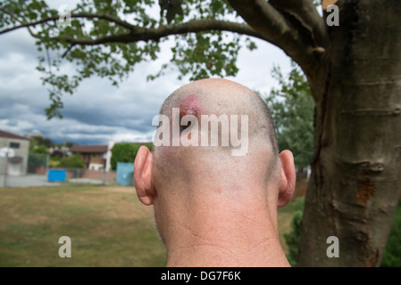 Pyogenic granuloma skin growth on mans head Stock Photo - Alamy