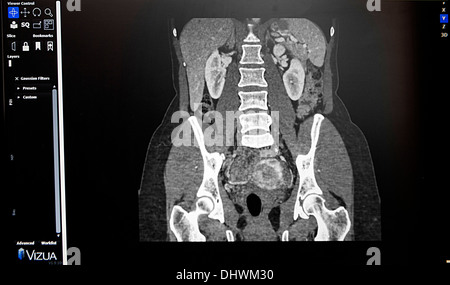 CT Scan of pelvic bone with both hip joint 3D rendering image Inlet ...