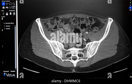 CT Scan of pelvic bone with both hip joint 3D rendering image Inlet ...