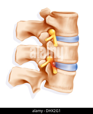 HERNIATED DISC, ILLUSTRATION Stock Photo - Alamy