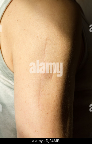 Removal of a lipoma Stock Photo - Alamy