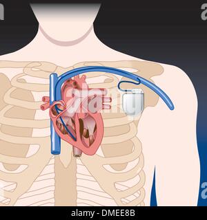vector illustration of heart and pacemaker. cardiology Stock Vector Image & Art - Alamy