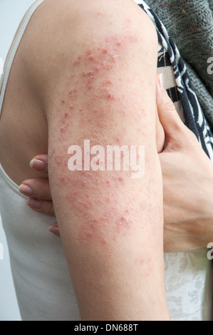 red rash girl Skin disease caused by allergies to drugs, food ...