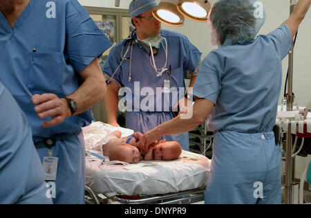Conjoined twins separated Stock Photo - Alamy