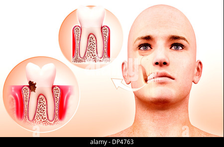Tooth decay disease as an unhealthy molar with periodontitis due to ...