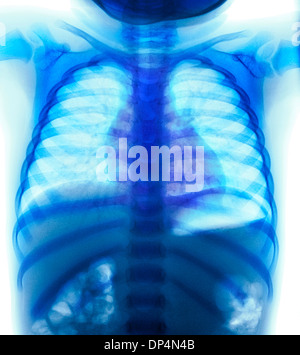 Swallowed coins, X-ray Stock Photo - Alamy