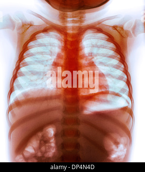 Swallowed coins, X-ray Stock Photo - Alamy