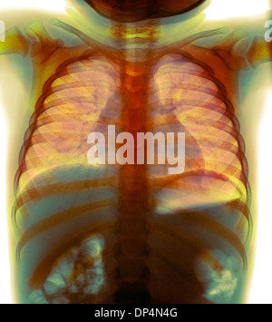 Swallowed coins, X-ray Stock Photo - Alamy