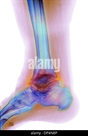 Osteoarthritis of the ankle, X-ray Stock Photo - Alamy