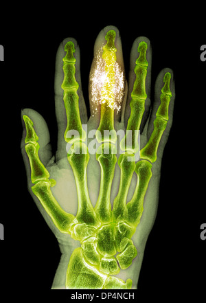 Foreign body in finger, X-ray Stock Photo - Alamy
