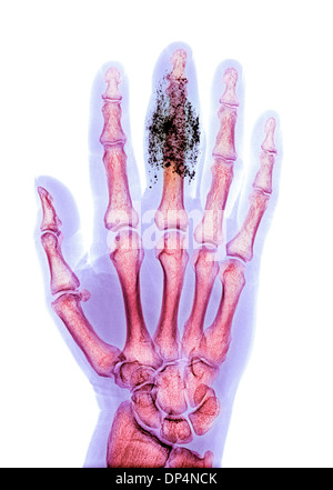 Foreign body in finger, X-ray Stock Photo - Alamy