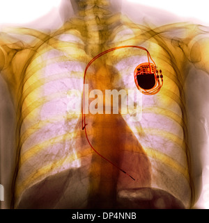 Dual chamber pacemaker, X-ray Stock Photo - Alamy