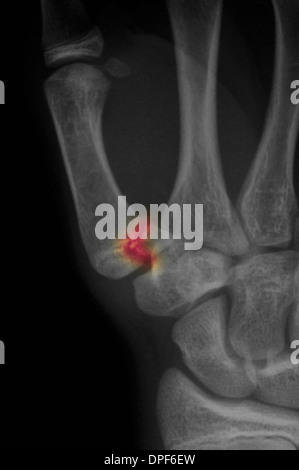 human thumb, x-ray image, fracture, human thumbs, thumb, thumbs ...