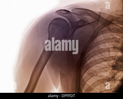 Normal shoulder, X-ray Stock Photo - Alamy