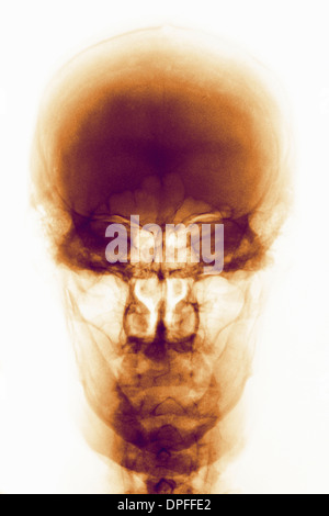 Normal skull, X-ray Stock Photo: 37879886 - Alamy