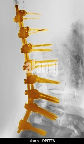 lumbar spine with spinal fusion hardware Stock Photo - Alamy