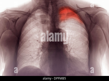 showing,x ray,rib fracture Stock Photo - Alamy