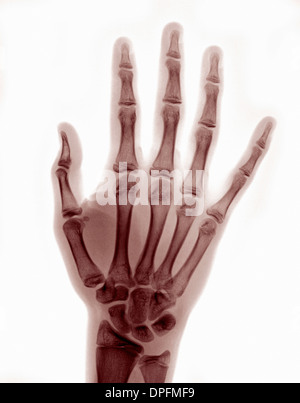 X-ray of hand showing thumb dislocation Stock Photo - Alamy
