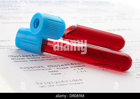 Triglyceride test result with blood sample in test tube on doctor hand ...
