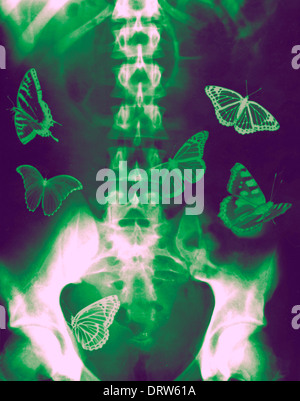 Concept - Butterflies in the stomach - x-ray of a human Abdomen with ...