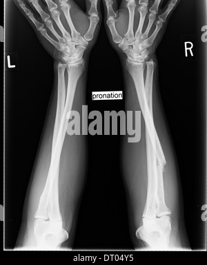Comparative X-ray of human forearms displays fracture of the right ...