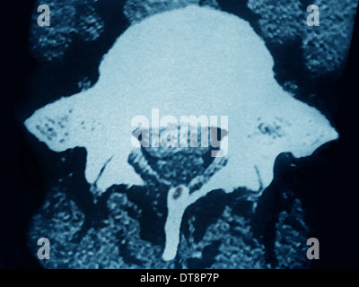 HERNIATED DISK, CT SCAN Stock Photo - Alamy
