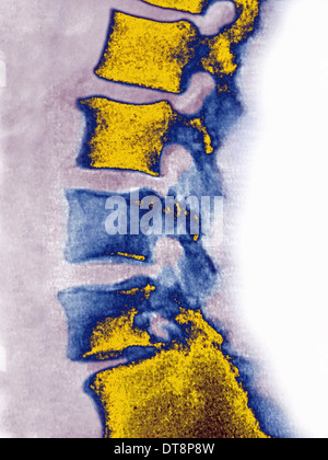 IVORY VERTEBRA, X-RAY Stock Photo - Alamy