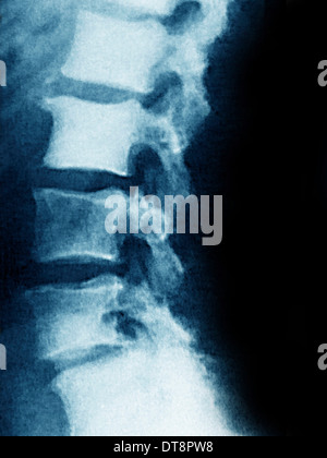 IVORY VERTEBRA, X-RAY Stock Photo - Alamy