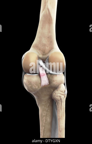 Illustration of a tear of the posterior cruciate ligament in a lateral ...