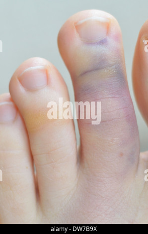 Sprained Toe, Left Foot Stock Photo - Alamy