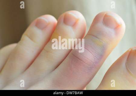 Sprained Toe, Left Foot Stock Photo - Alamy