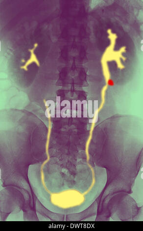 RENAL LITHIASIS, X-RAY Stock Photo - Alamy