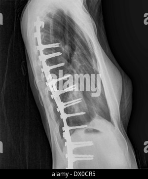Spinal fusion, also known as spondylodesis or spondylosyndesis, x-ray ...