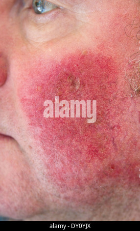 Close-up of red and inflamed skin behind the knee of a 19 year old male ...