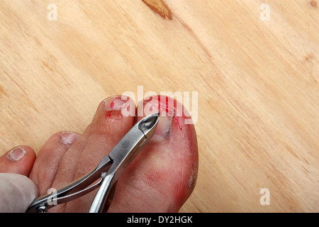 Surgery on a broken bleeding toe nail a man Stock Photo - Alamy